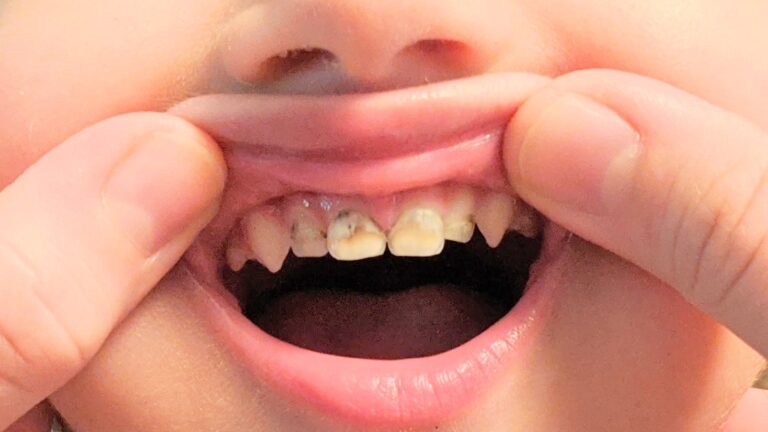 What Causes Teeth Discoloration in Children and How to Treat it • MAMA ...
